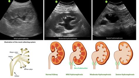 Sonographic Appearance Of Hydronephrosis And Its Qualitative Grading Download Scientific