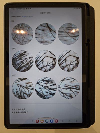 르포 탈모 위험 4단계ai 진단에 지갑이 열렸다