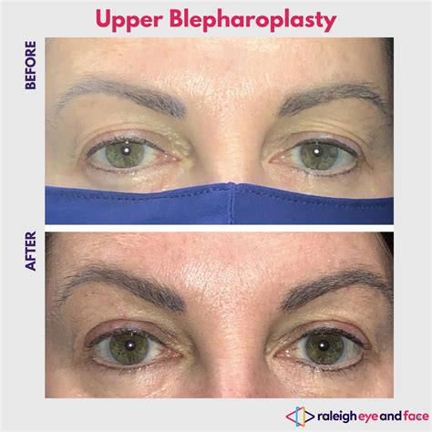 Upper Blepharoplasty Before And After Gallery — Raleigh Eye And Face