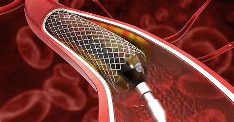 冠状动脉造影（cag）和经皮冠状动脉介入治疗（pci） Bangkok Heart Hospital