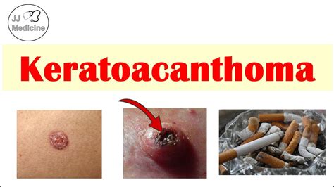 Keratoacanthoma Rapidly Growing Skin Lesion Risk Factors Stages