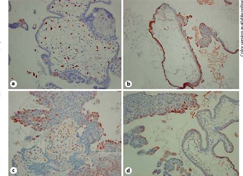 Figure 1 From Analysis Of Rcas1 Immunoreactivity Within Hydatidiform