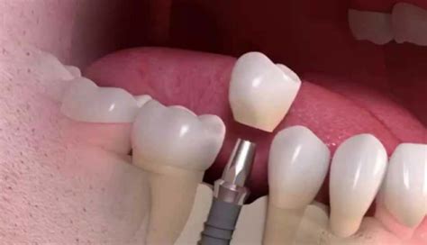 How To Slow Down Bone Loss In Teeth Soft Touch Dental