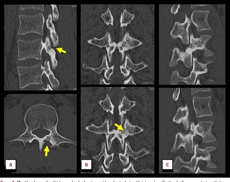 Figure 1 From Osteoid Osteoma Can Occur At The Pars Interarticularis Of The Lumbar Spine