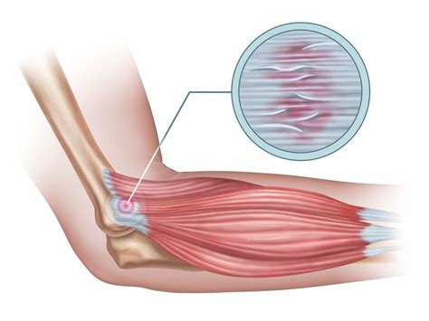 Tennis Elbow Causes Symptoms And Treatment Tennis Uni