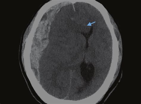 Acute Subdural Hematoma Extra Axial Hyperdense Area Along Calvarium Of Download Scientific
