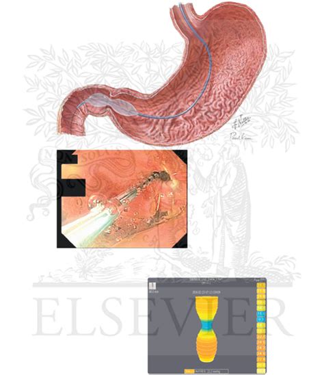 Diagnostic Tests In Gastric Disorders Endoflip Of The Pylorus