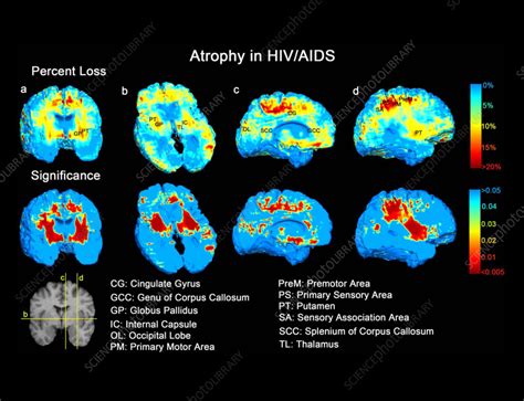 Brain Atrophy In Hivaids Mri Scans Stock Image C0582245