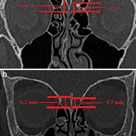 Measurements From The Frontal Skull Base Depth Of The Olfactory Fossa Download Scientific