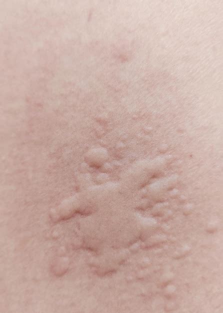 Bumpy Rash Images Free Download On Freepik Bumpy Rash Images Free Download On Freepik