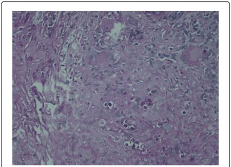 Periodic Acid Schiff Staining With The Presence Of Cryptococcus Download Scientific Diagram