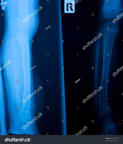 X Ray Film Tibia Leg Fracture Stock Photo Edit Now