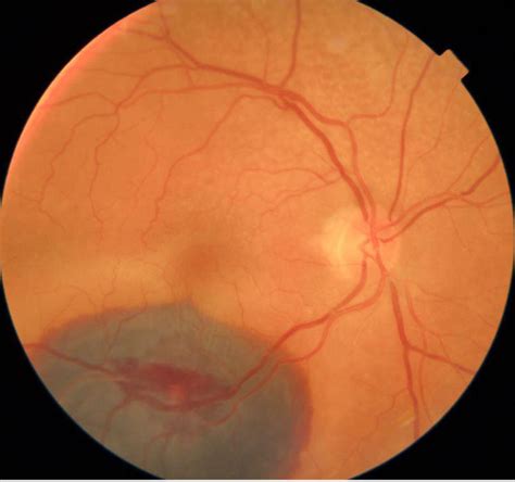 Retinal Artery Macroaneurysm R Optometry