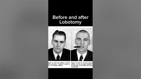 People Before And After Lobotomy 1940s 1960s Youtube
