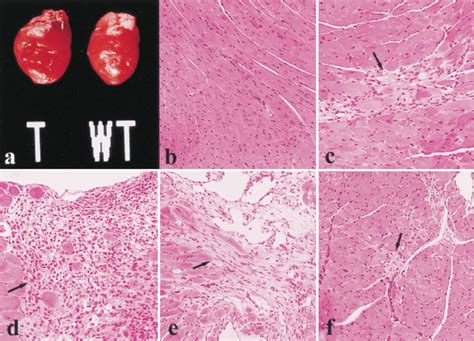 Cardiac Pathology In Transgenic Mice Overexpressing Pkc2 Isoform At 11 Download Scientific