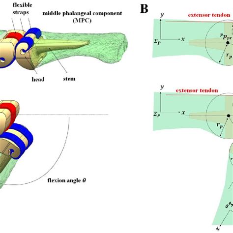 PDF Novel Implant Design Of The Proximal Interphalangeal Joint Using An Optimized Rolling
