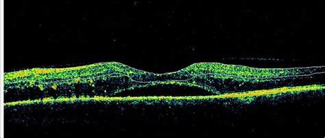 Filesubretinal Hyporeflectiivity Seen In Smd Eyewiki