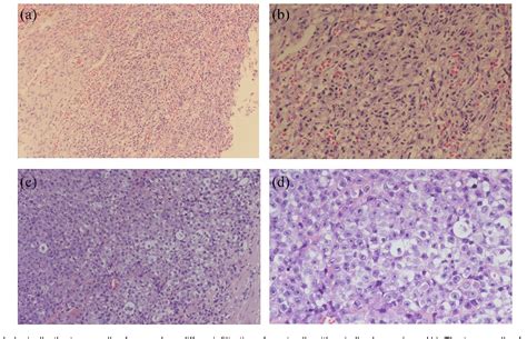 Figure 1 From Mast Cell Sarcoma Of The Retroperitoneum With Concurrent