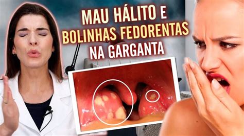 Como Eliminar Mau Cheiro Na Garganta Dicas E Tratamentos Actualizado