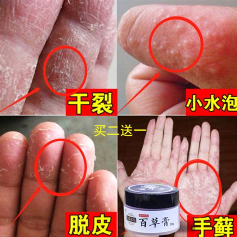 汗疱疹和湿疹的区别 汗疱疹和湿疹的图片 第4页 大山谷图库