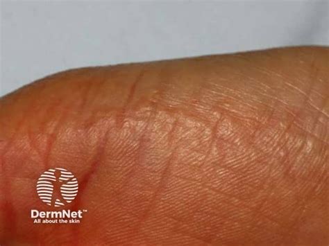 Acrokeratoelastoidosis