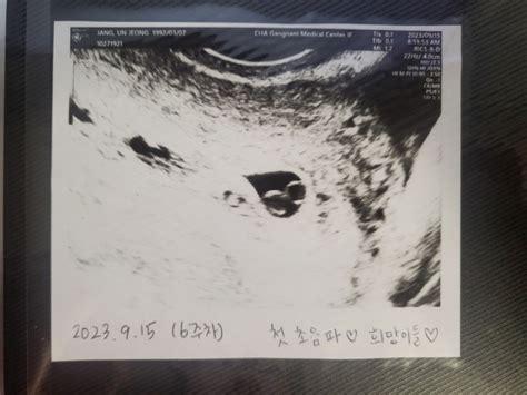 일란성 쌍둥이 시험관 성공 후 임신기록 6주~15주 강남차병원 임신확인 난임병원 졸업 네이버 블로그