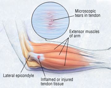 Tennis Elbow Lateral Epicondylitis Harvard Health