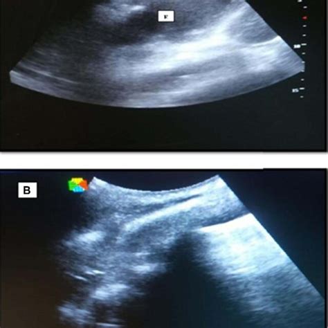 Thoracic Ultrasound A Complex Pleural Effusion With Loculation B Download Scientific