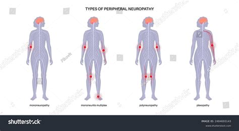 Types Peripheral Neuropathy Mononeuropathy Mononeuritis Multiplex Stock