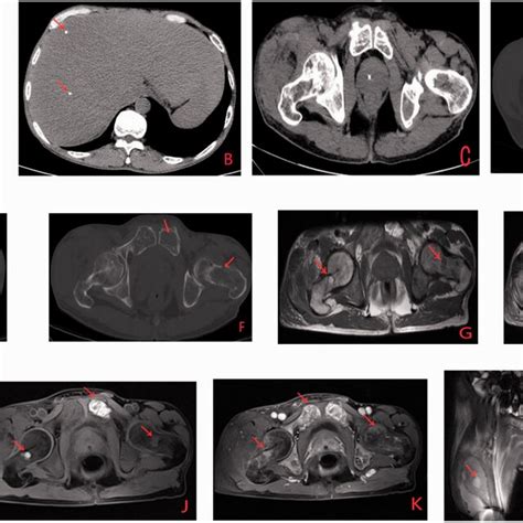 A Chest Axial Ct Showed Multiple Fine Nodules In Both Lungs B Download Scientific Diagram