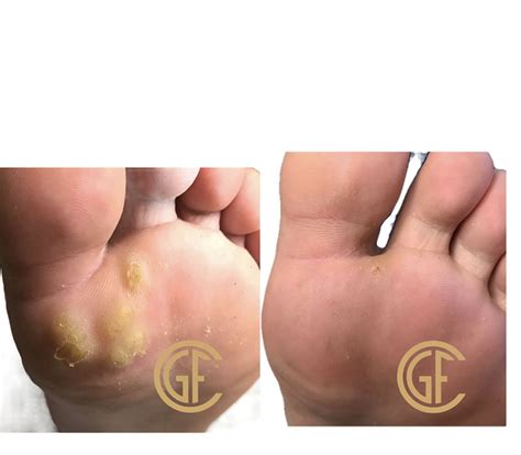 Plantar Warts Before And After Patient 03 Gotham Footcare