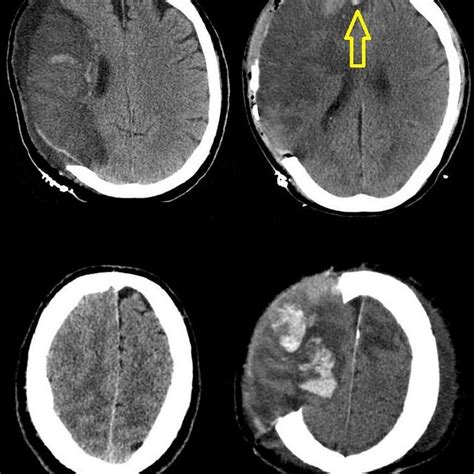 Above Left—axial Ct Scan Of Patient From Se Group Above Right—axial Ct