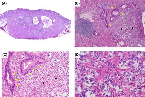 Histological Findings Of The Resected Sample By Endoscopic Submucosal Download Scientific