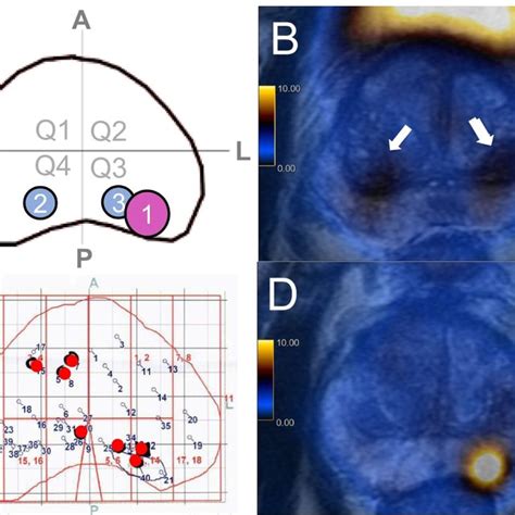 Example Of The Method Used For Lesion Localization A Readout Of Psma