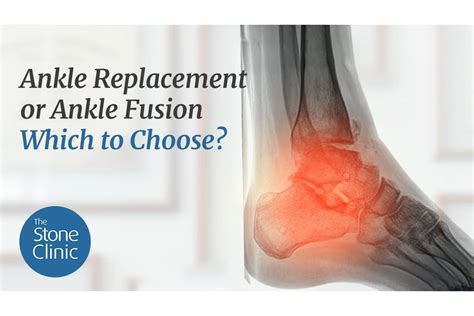 Ankle Replacement Or Ankle Fusion Which To Choose Video Blog