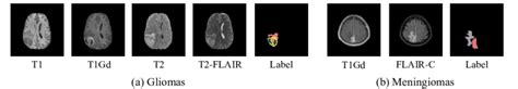 Multi Modal Mris For A Gliomas And B Meningiomas Download Scientific Diagram