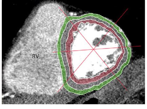 Segmentation Of Left Ventricular Myocardium Left Ventricular Download Scientific Diagram