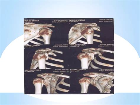 Shoulder Sports Related Injuries Pptx