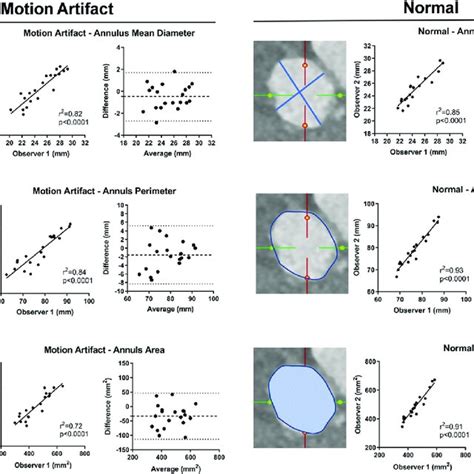 Interobserver Variability Correlation Left And Bland Altman Plots