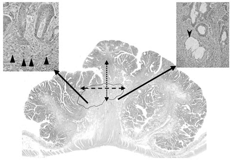Adverse Prognostic Factors Of Colorectal Submucosal Invasive Carcinoma Download Scientific