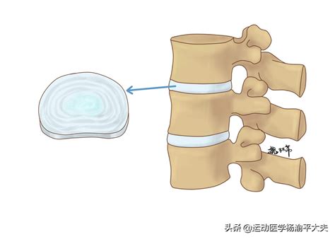 按摩不可以缓解腰椎间盘突出症，因为腰椎间盘突出症是腰椎间盘向后突 今日头条