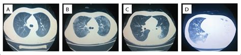 Figure 1 From Acute Wt1 Positive Promyelocytic Leukemia With Hypogranular Variant Morphology