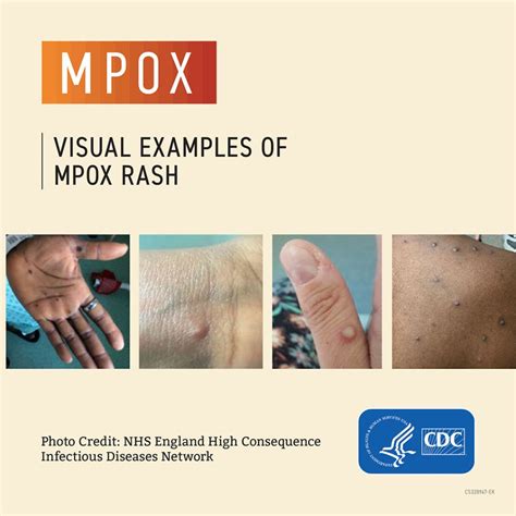 What To Know About Mpox City Of Columbia Missouri