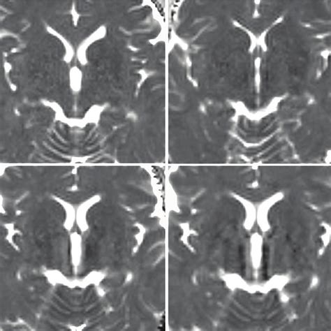 Pdf Csf Pulsation Artifacts On Adc Maps Obtained With Readout Segmented Epi