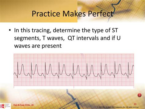 Ppt St Segments T Waves Qt Intervals And U Waves Powerpoint Presentation Id 7068789