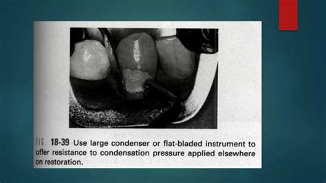 Class V Tooth Preparation For Amalgam Restorations Pptx