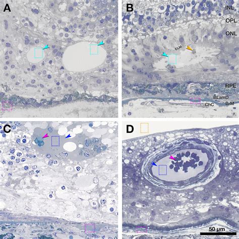 Intraretinal Fluid Versus Intravascular Plasma In Eyes With Neovascular Download Scientific