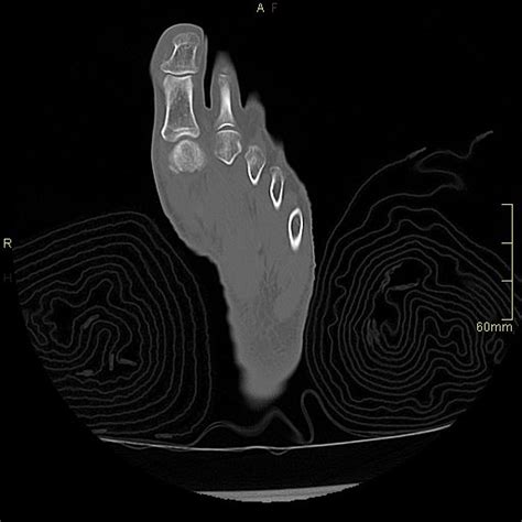 Chaput Tubercle Fracture Radiopaedia 80319 93956 Axial Non Contrast Nc Commons