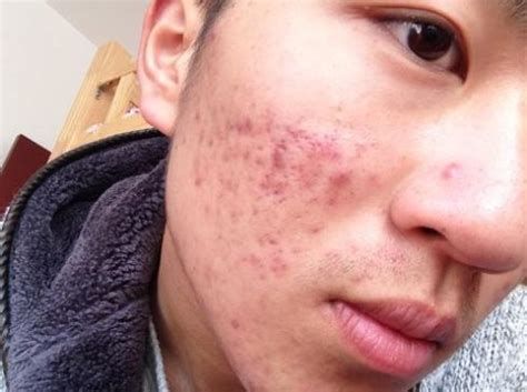 痘印怎么去除比较好教你一个去除痘印的小妙招