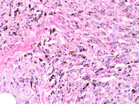 Smoking Related Interstitial Fibrosis Patterns Of Pulmonary Pathology
